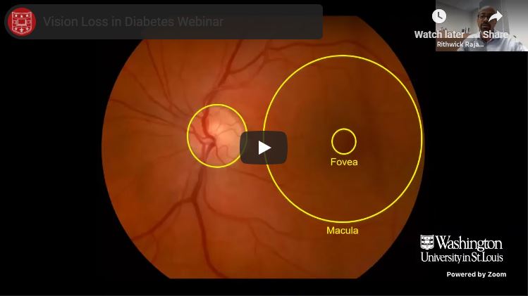 Vision Loss in Diabetes | Ophthalmology & Visual Sciences