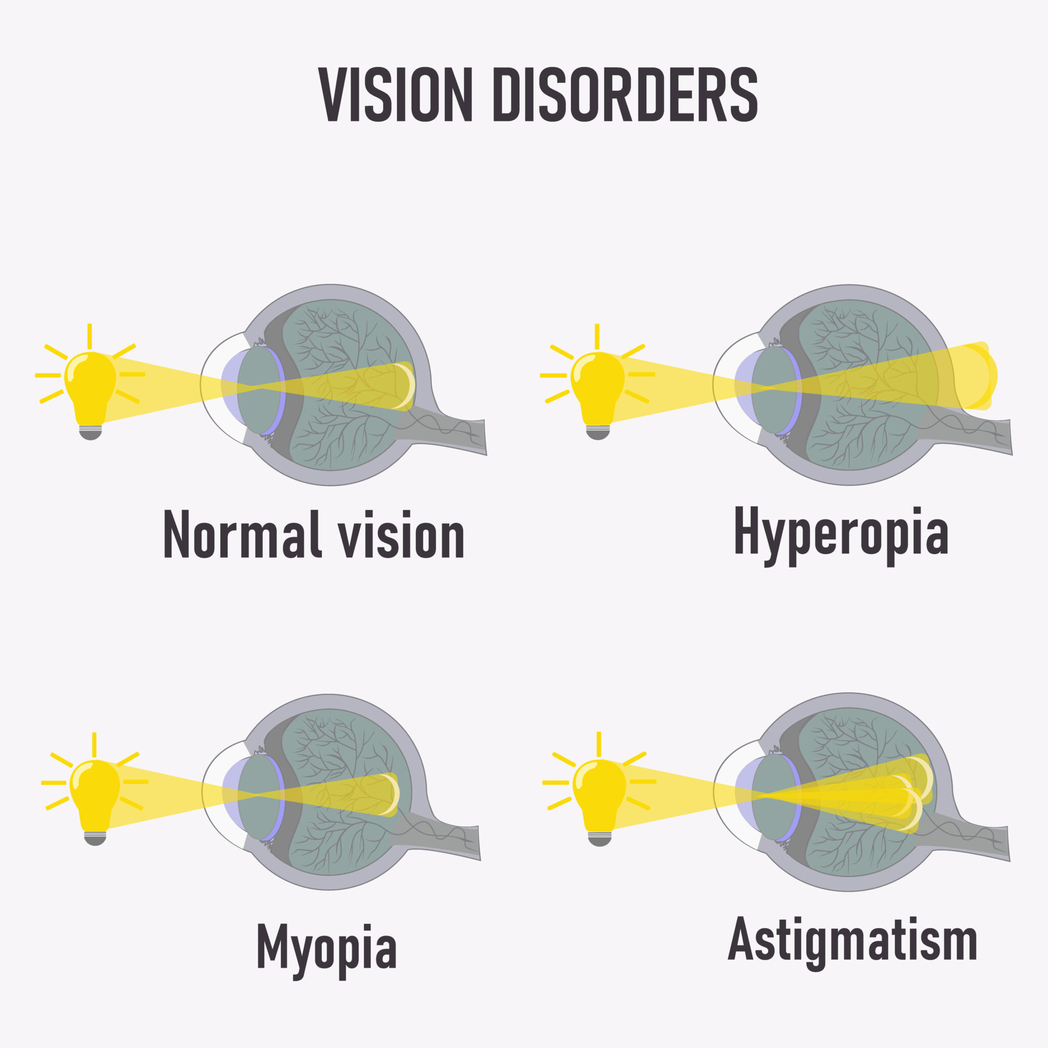 Guide to Refractive Errors | Patient Education